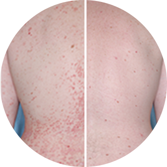 Moderate to Severe Scalp Psoriasis Results - Otezla® (apremilast)