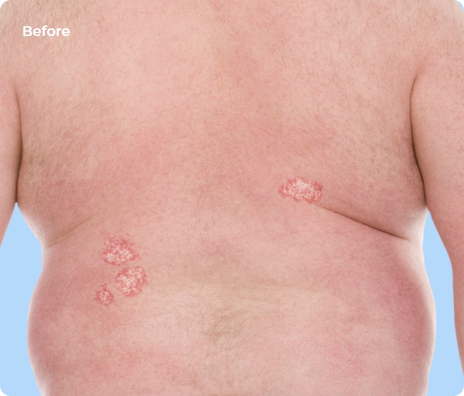 Before and After Results | Otezla® (apremilast) for PsO