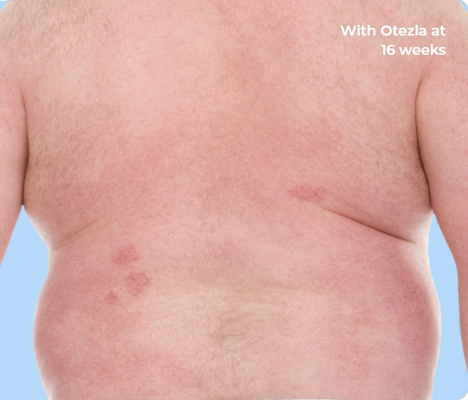 Before and After Results | Otezla® (apremilast) for PsO