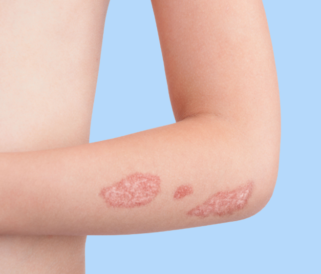 Before and After Results | Otezla® (apremilast) for PsO